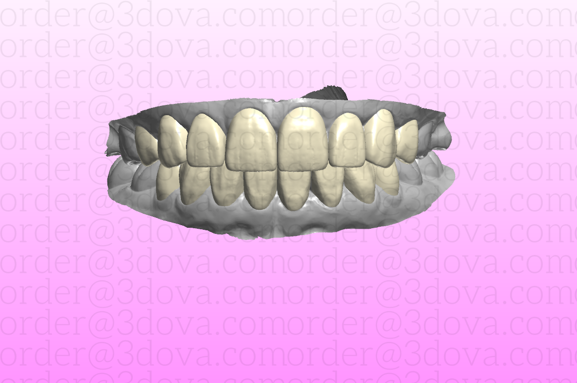 Cantilever PFM Bridge Archives - 3Dova Digital Dental Lab